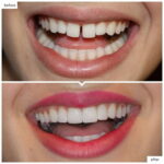 Dental Veneers vs Crowns: Pros, Cons, and Best Fit