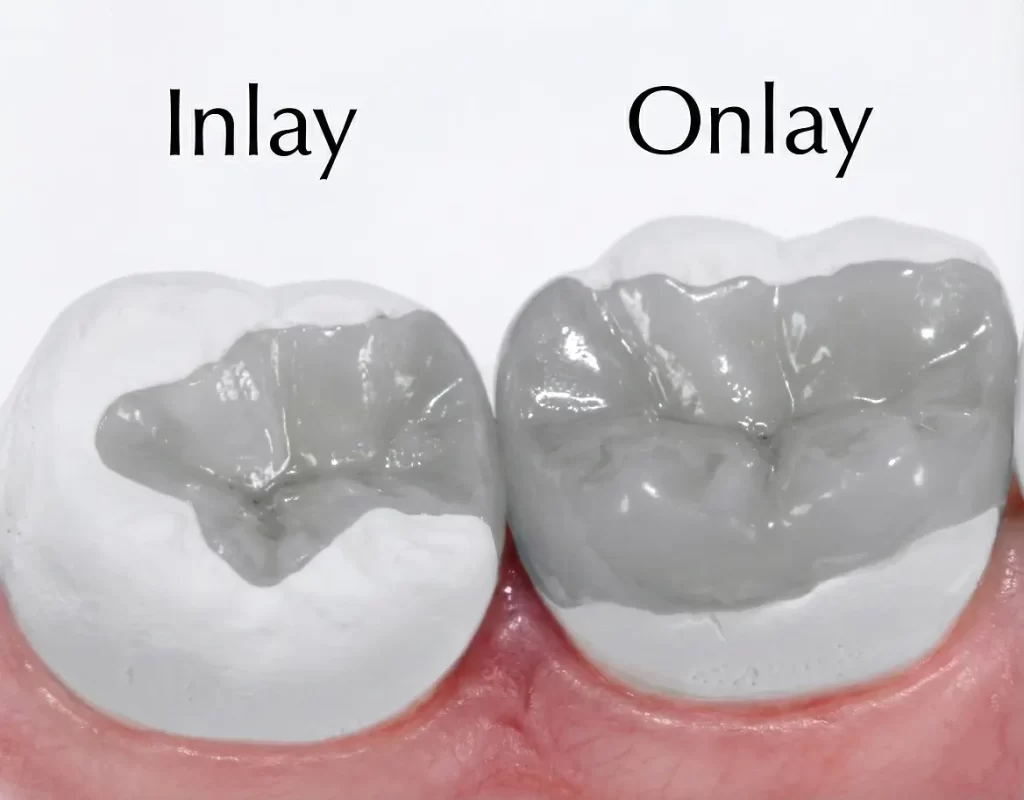 Dental Inlays & Onlays Toronto - pearl | +16478000318